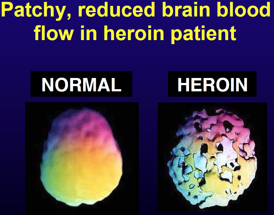 Addicted Brain Addicted Brain